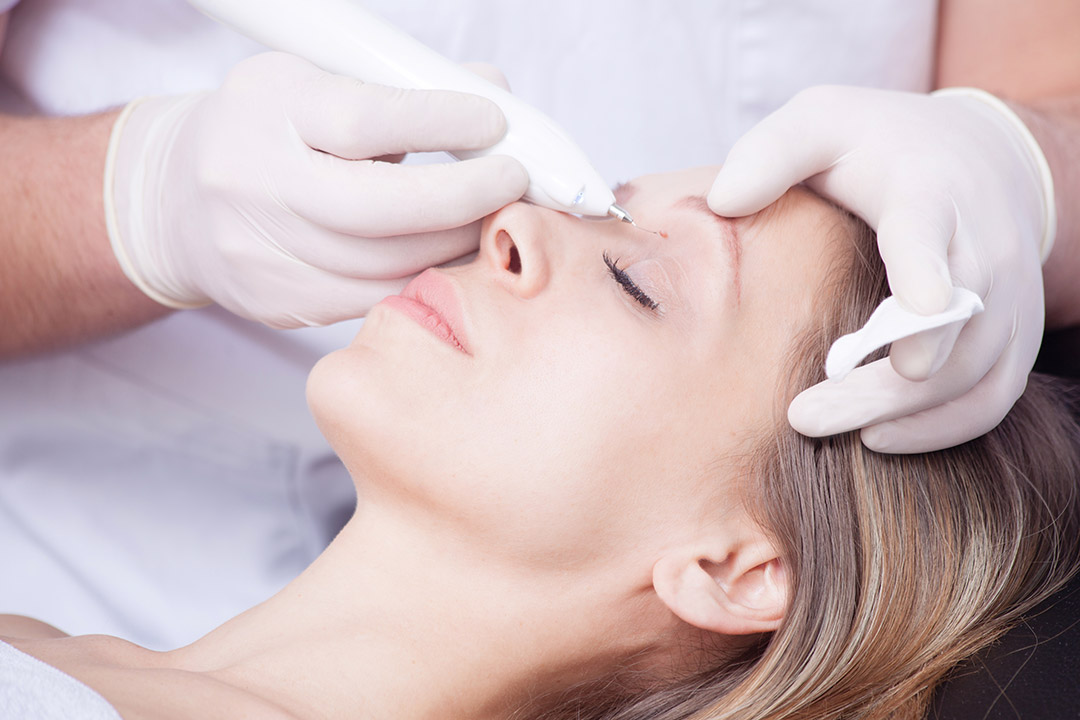 Skin Tags Removal - Elysium Beauty Clinic